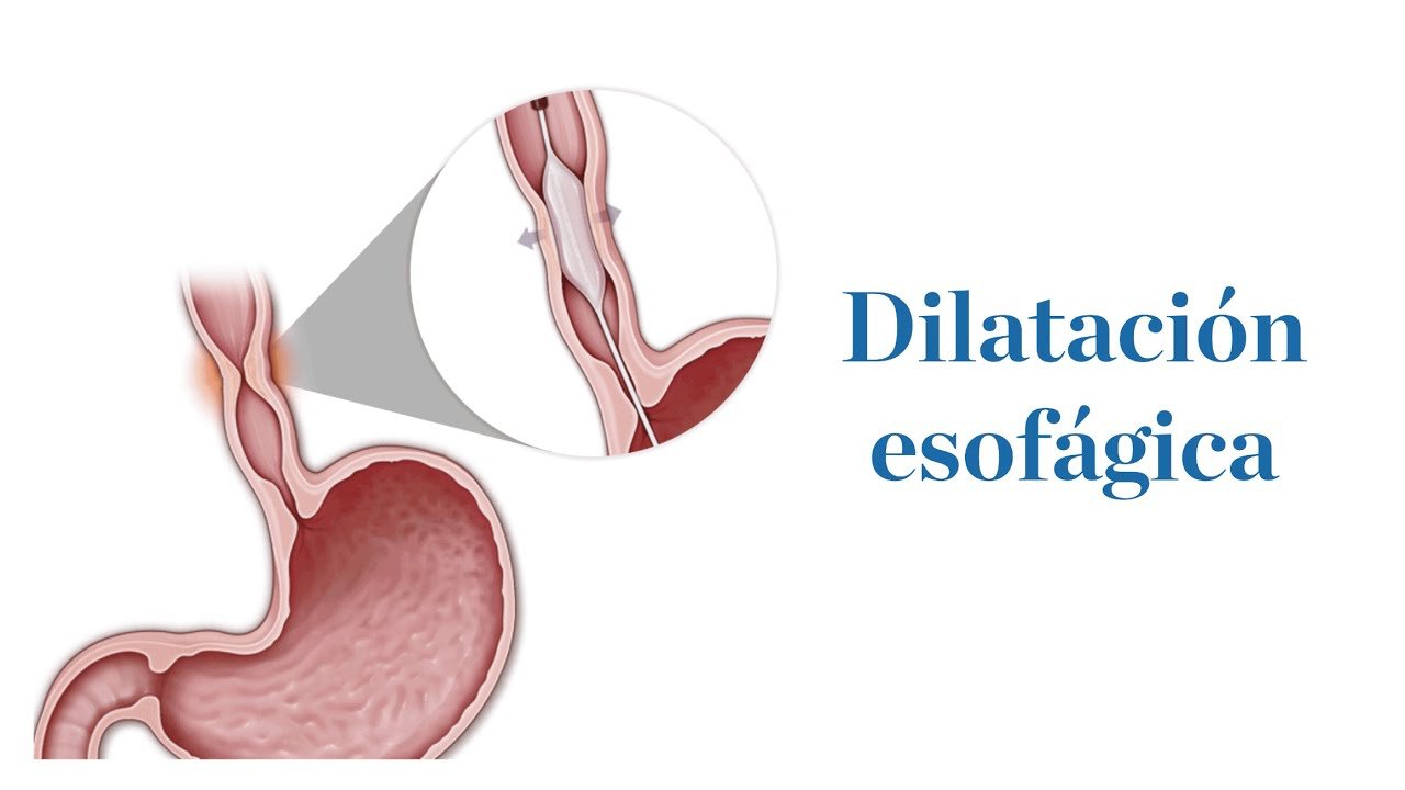 Redes Esofagicas