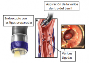 LIGADURA ENDOSCÓPICA DE VARICES ESOFÁGICAS Y GÁSTRICAS - Incide S.A.S ...